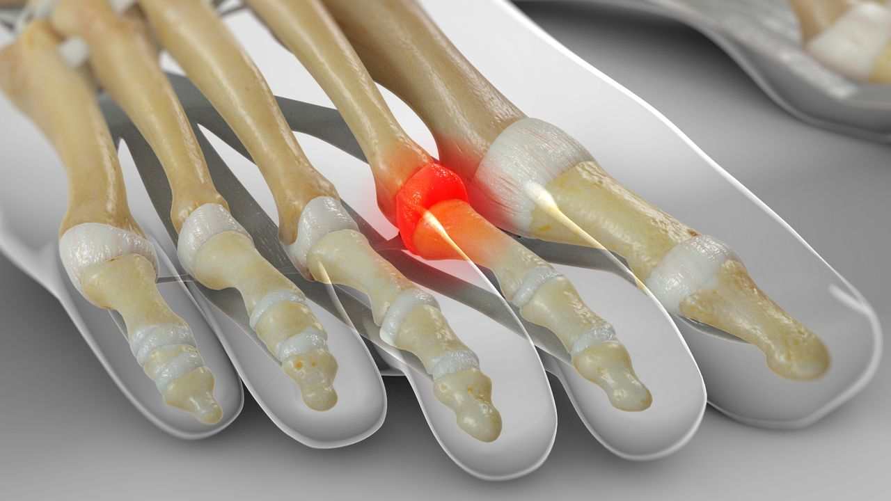 Capsulitis Causes & Treatment - Priority Podiatry